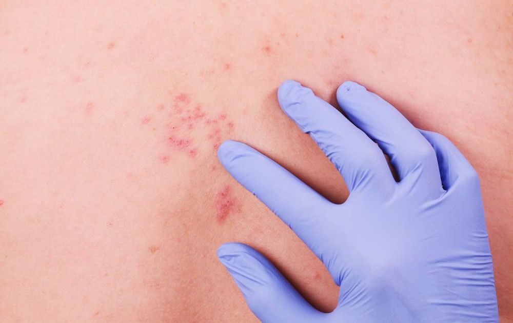 Ministério da Saúde decide não incorporar vacina herpes zóster ao SUS ...