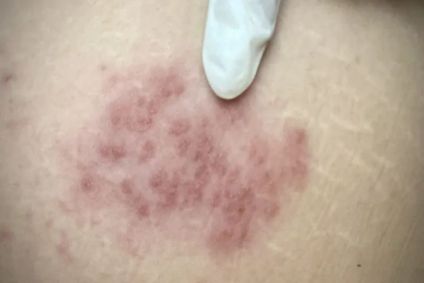 Herpes Zoster: causas, sintomas e como fazer o tratamento?