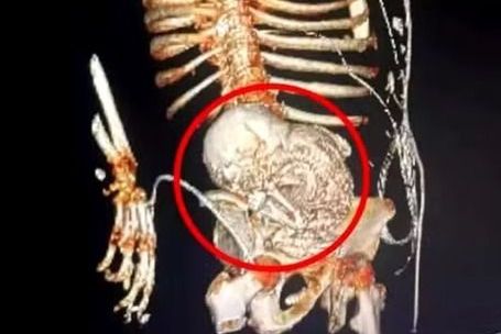 "Bebê de pedra": idosa descobre feto calcificado e morre após cirurgia ...