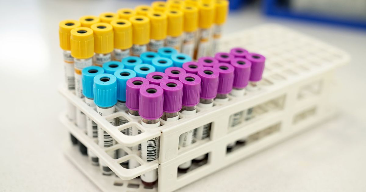 Proteína C Reativa (PCR): o que é, para que serve e quando fazer o ...