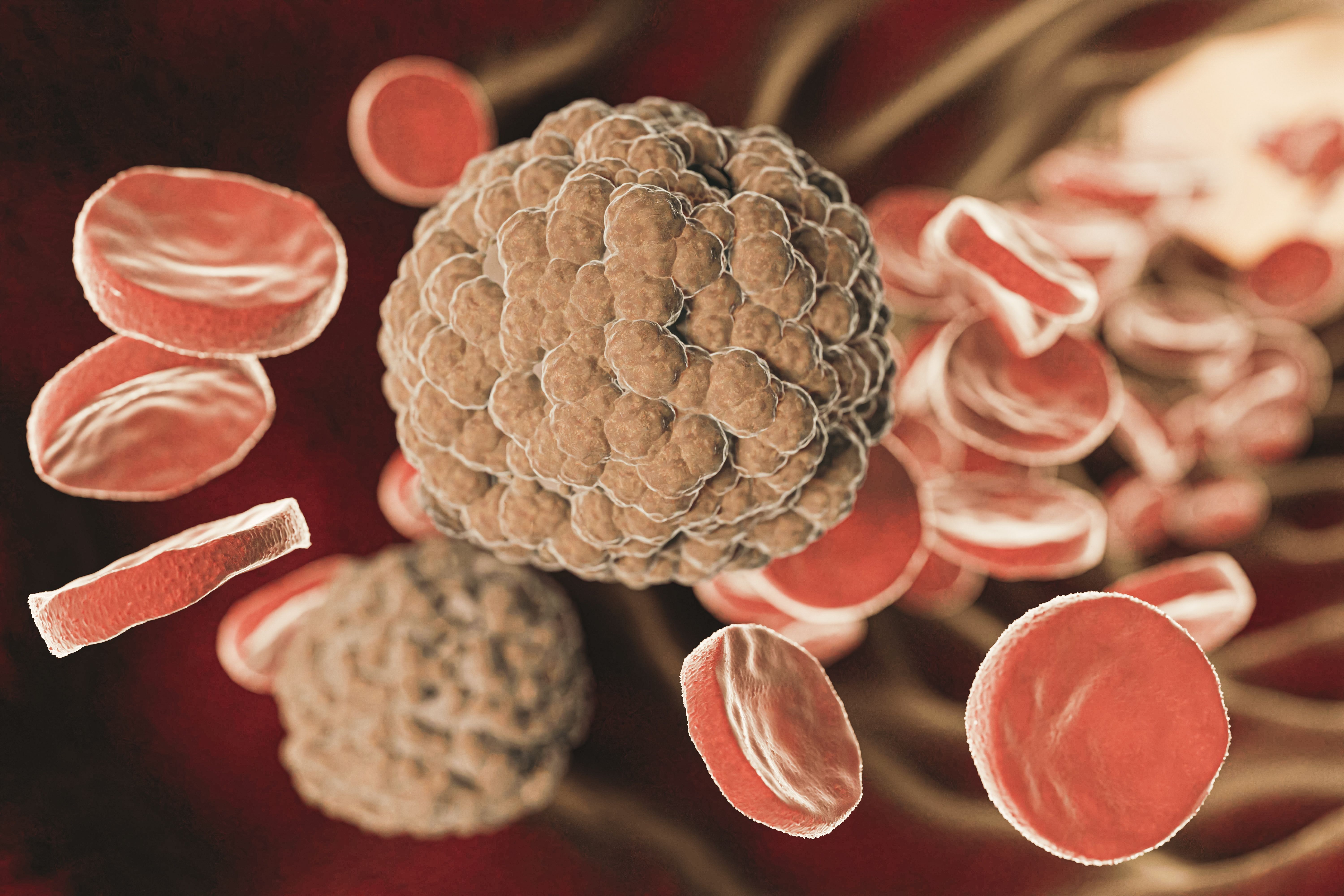 Linfoma de Hodgkin é mais comum em jovens: entenda mitos e verdades ...