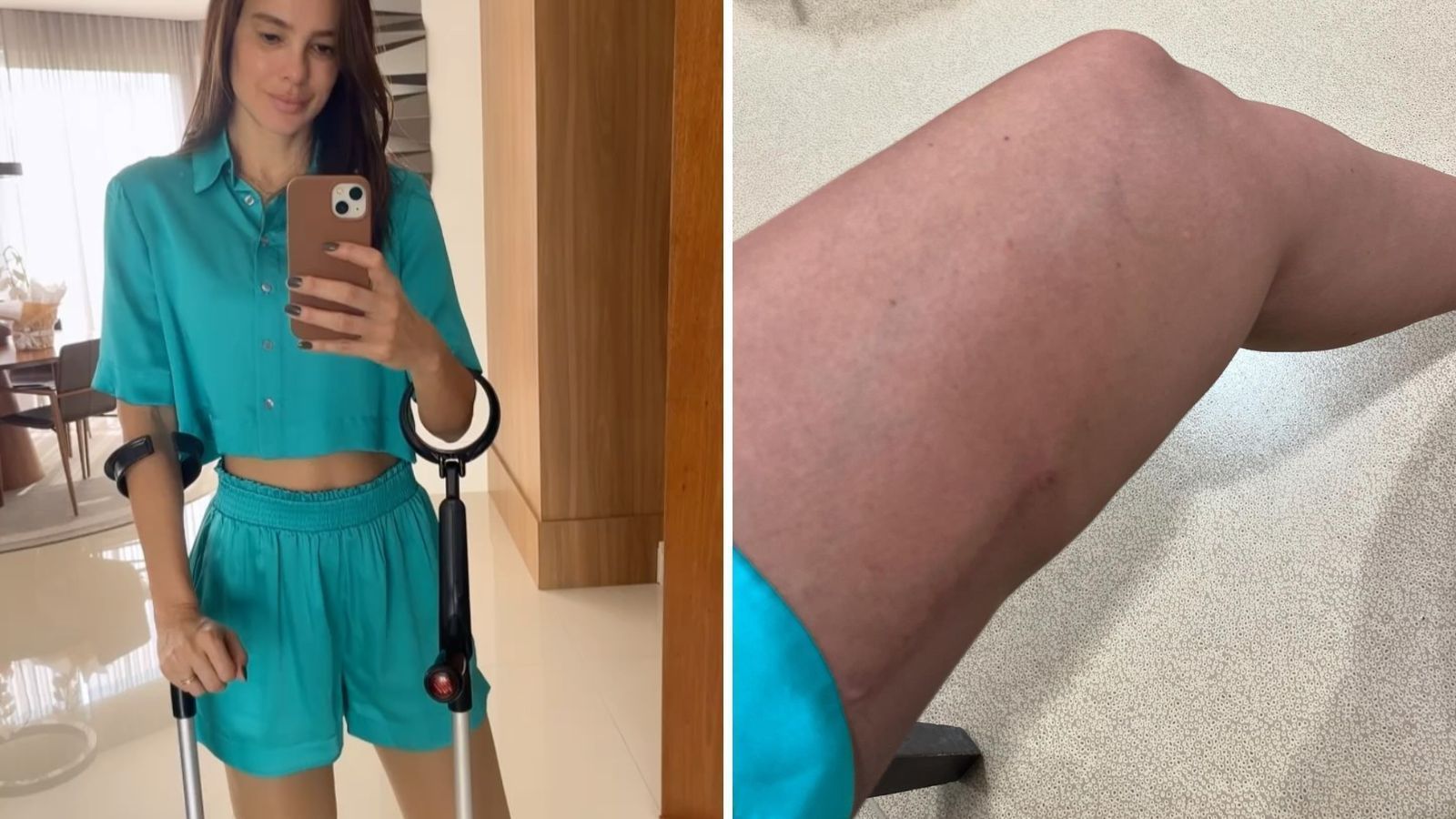 Vera Viel mostra recuperação da perna após cirurgia de câncer | CNN Brasil