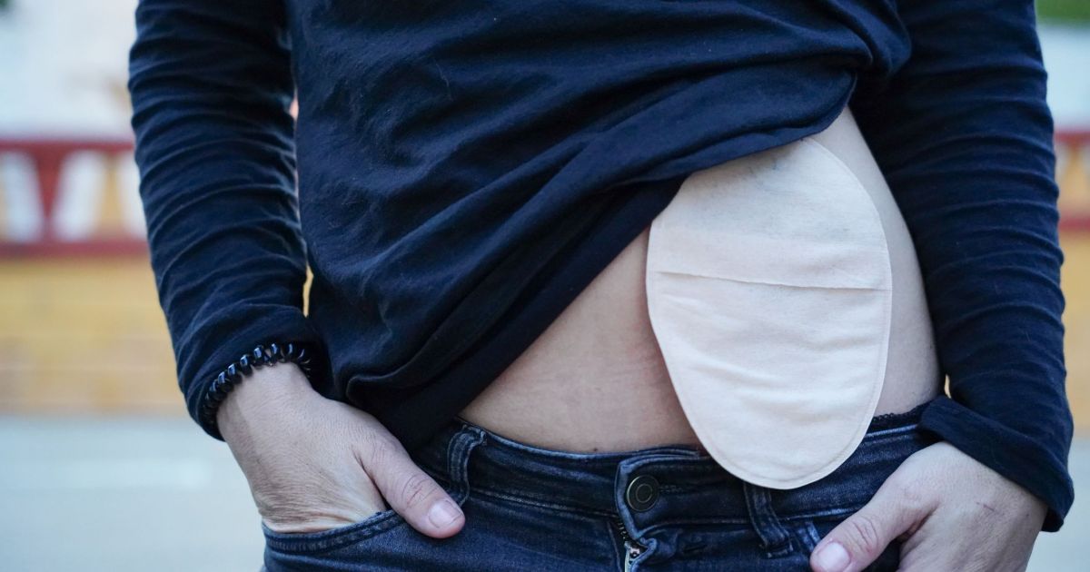 Bolsa de colostomia: o que é, para que serve e cuidados | CNN Brasil