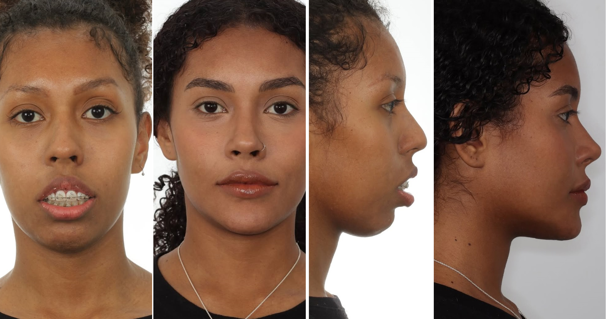 BBB25: Giovanna Jacobina sobre mudanças no rosto: "O antes é pavoroso ...