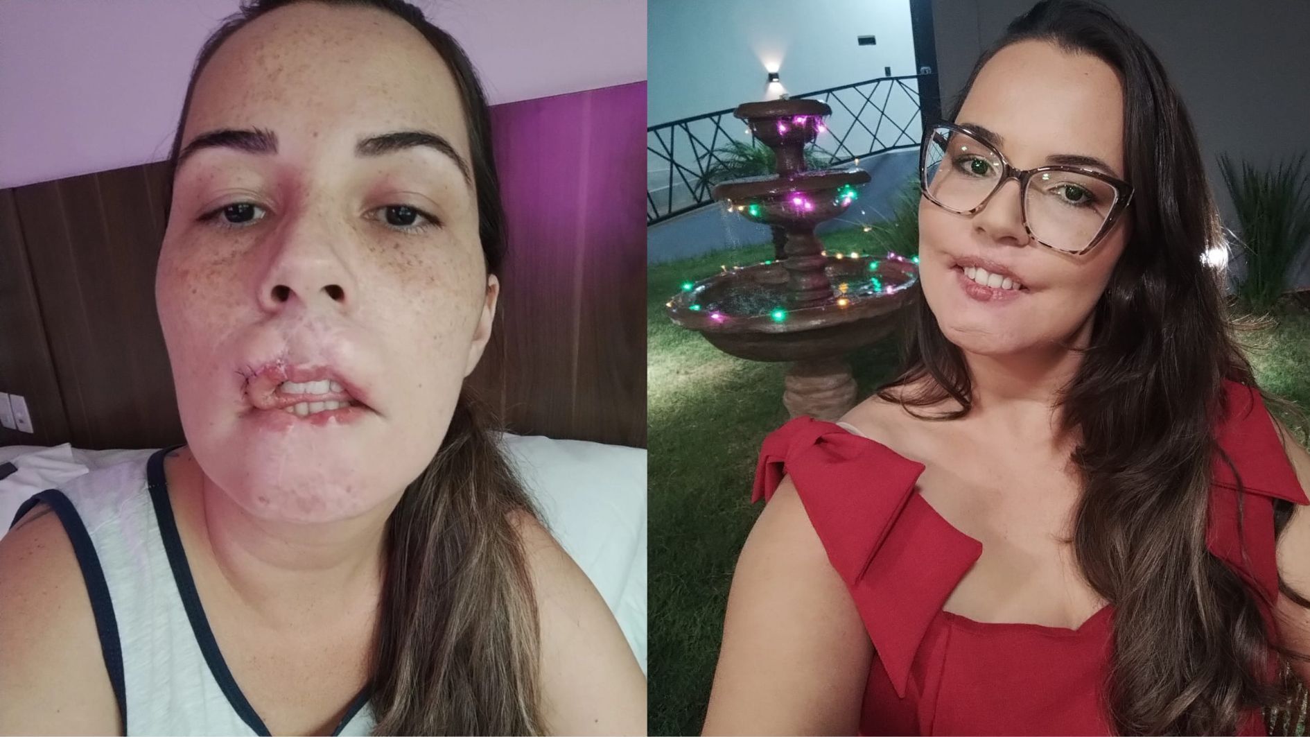 Falta de qualificação faz aumentar incidentes em procedimentos faciais ...