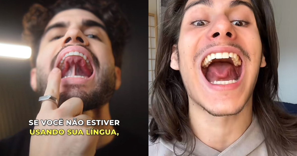 Mewing define a mandíbula? Conheça riscos do exercício viral do TikTok ...