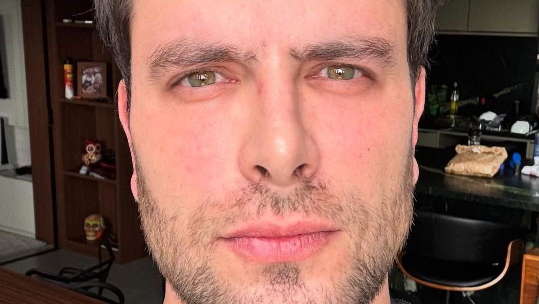 Ex-BBB Gustavo mostra resultado de implante capilar: "Um calvo morria ...