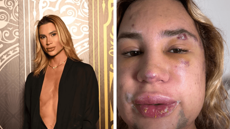 Quem foi Junior Dutra, influenciador que morreu após procedimento estético | CNN Brasil